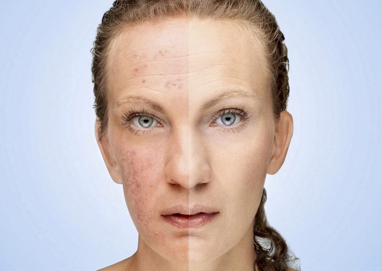 Alimentation alcaline : alimentation anti-acné.